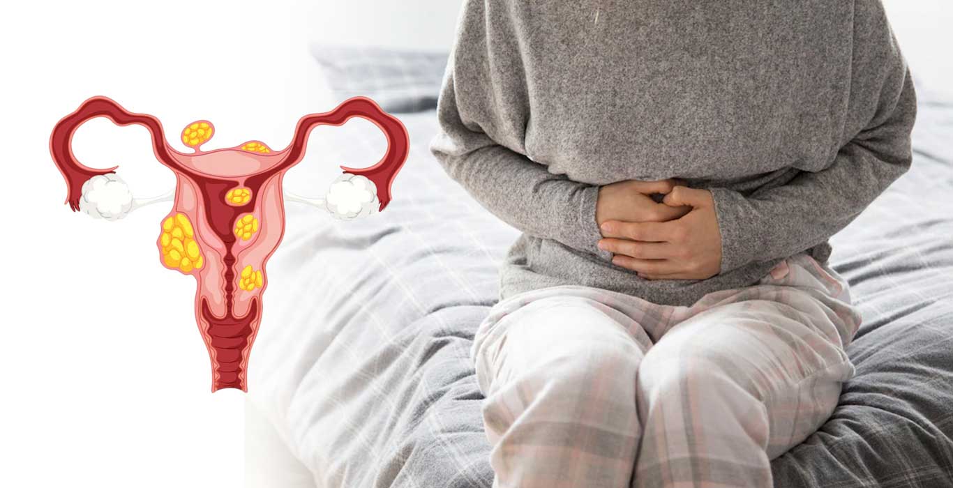 Fibroid meaning in Hindi? complete guide on Fibroid